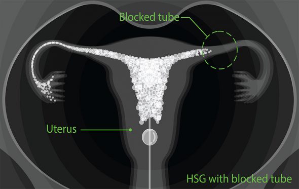 HSG Test / Fallopian Tube Testing - KL Fertility Centre